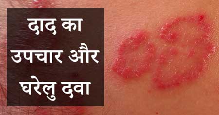 दाद का उपचार और घरेलु दवा - Daad ka ilaj Hindi